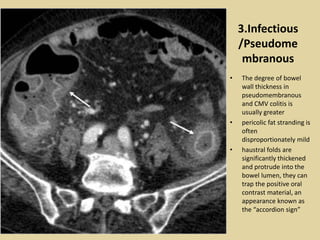 Bowel wall thickening at ct | PPTX