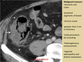 Bowel wall thickening at ct | PPTX