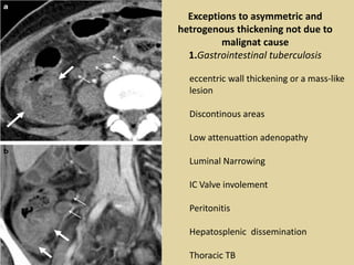Bowel wall thickening at ct | PPTX