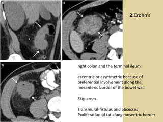 Bowel wall thickening at ct | PPTX