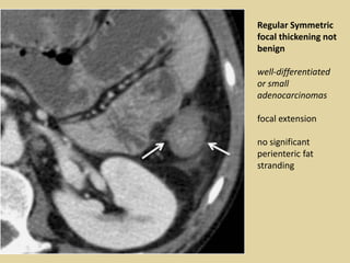 Bowel wall thickening at ct | PPTX