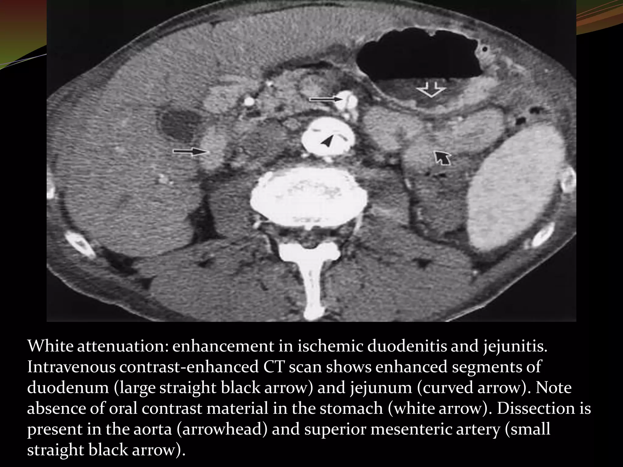 CT Imaging of Bowel Wall Thickening | PPTX