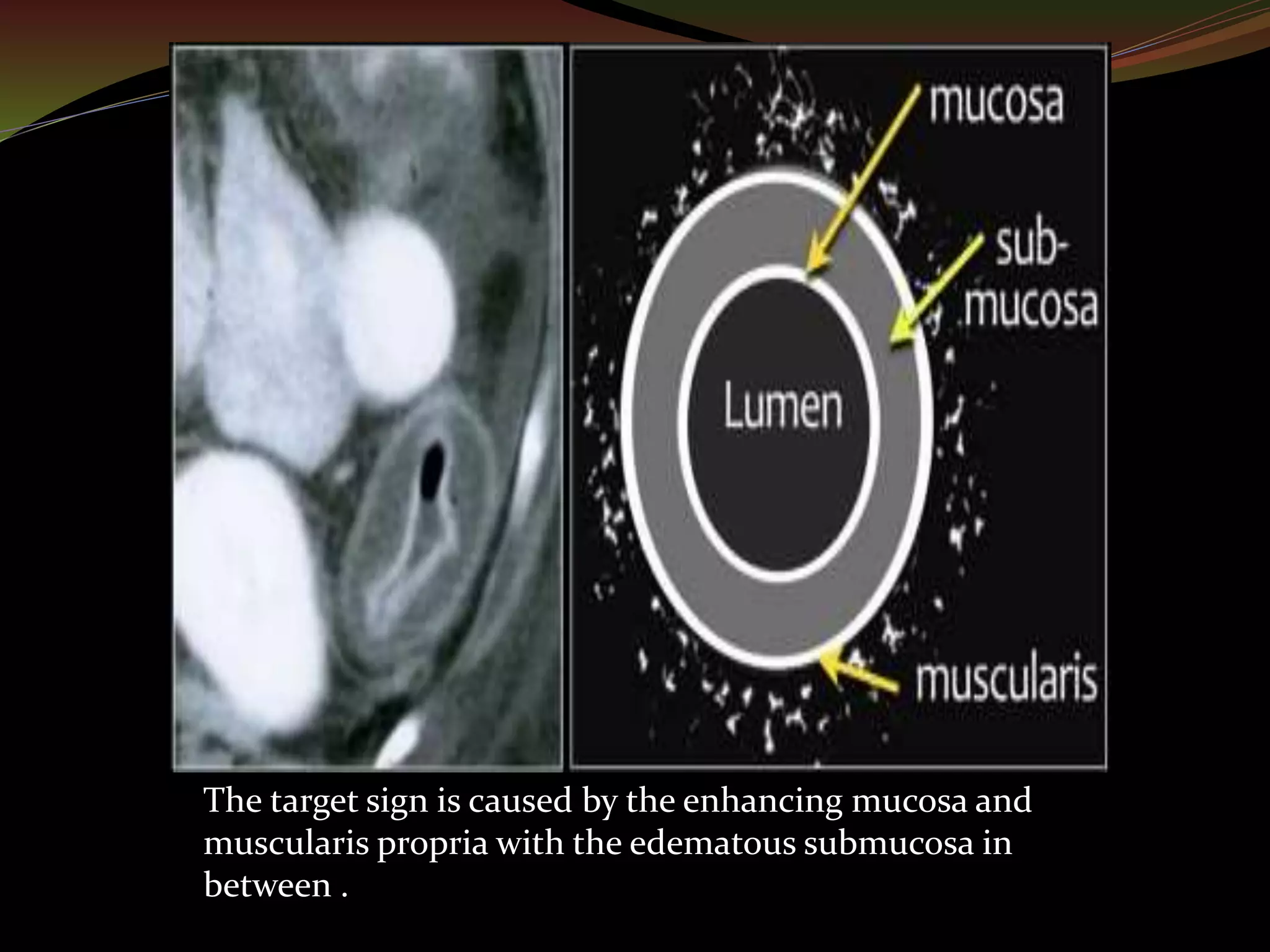 CT Imaging of Bowel Wall Thickening | PPTX