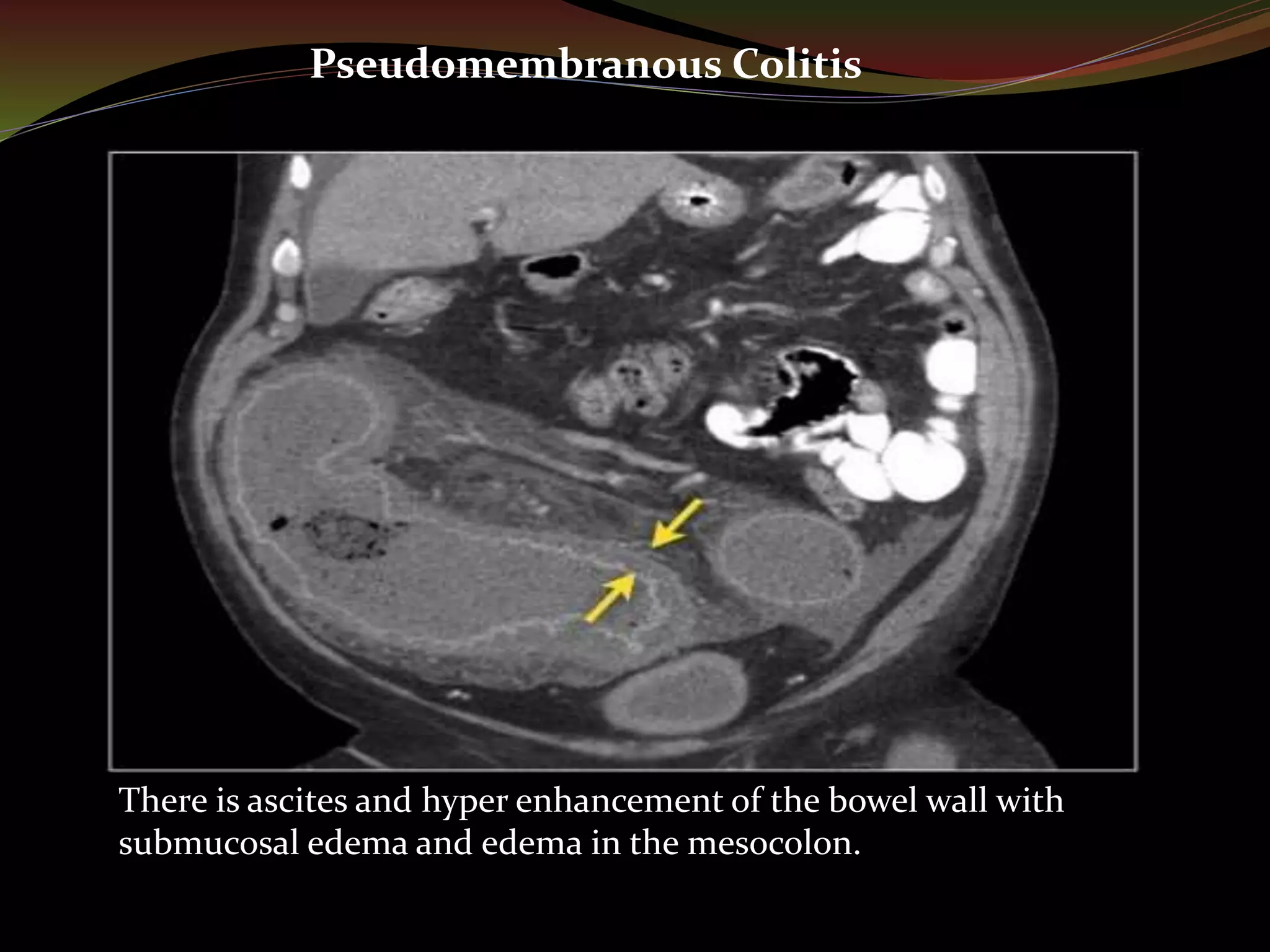 CT Imaging of Bowel Wall Thickening | PPTX