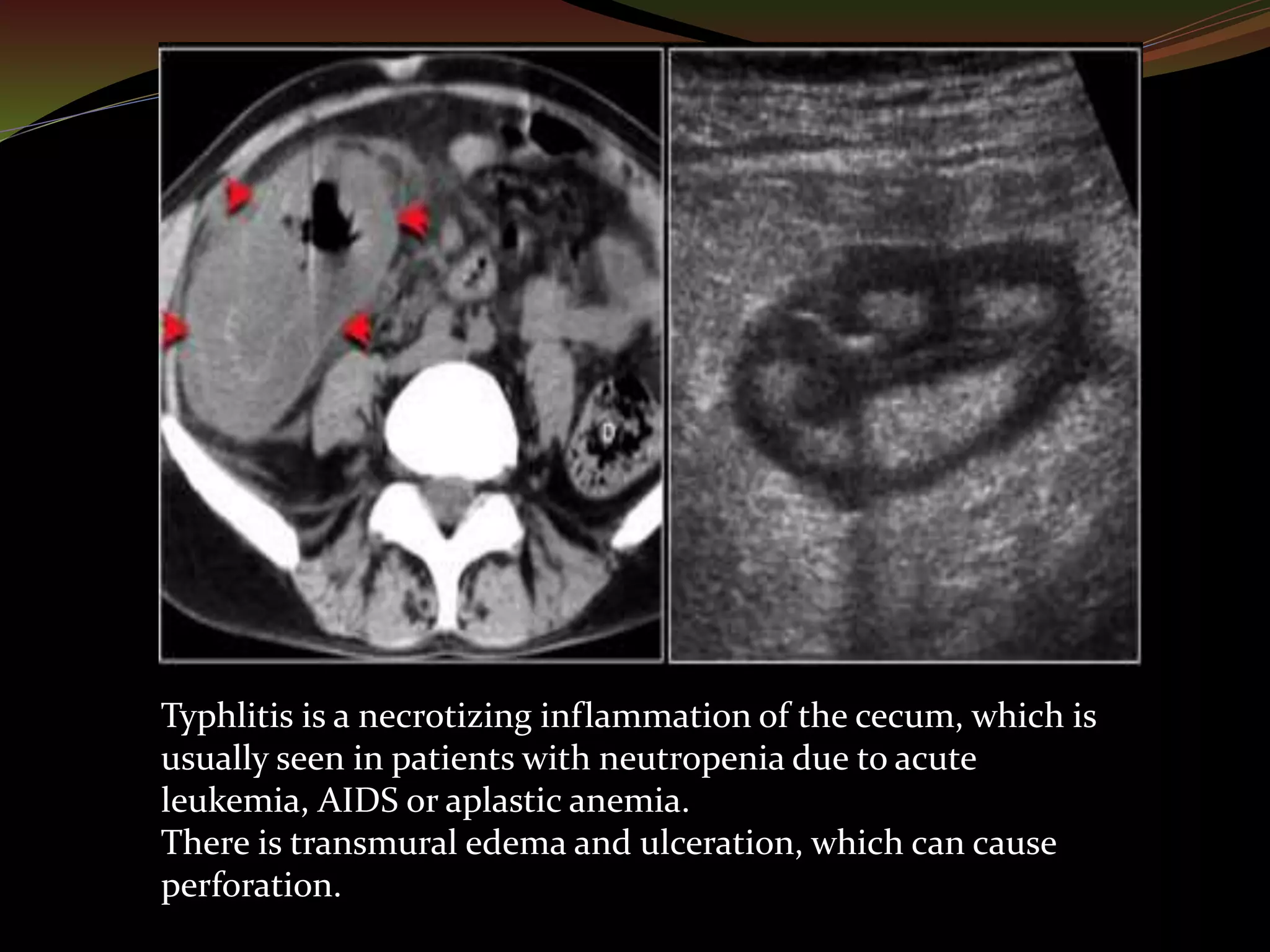 CT Imaging of Bowel Wall Thickening | PPTX