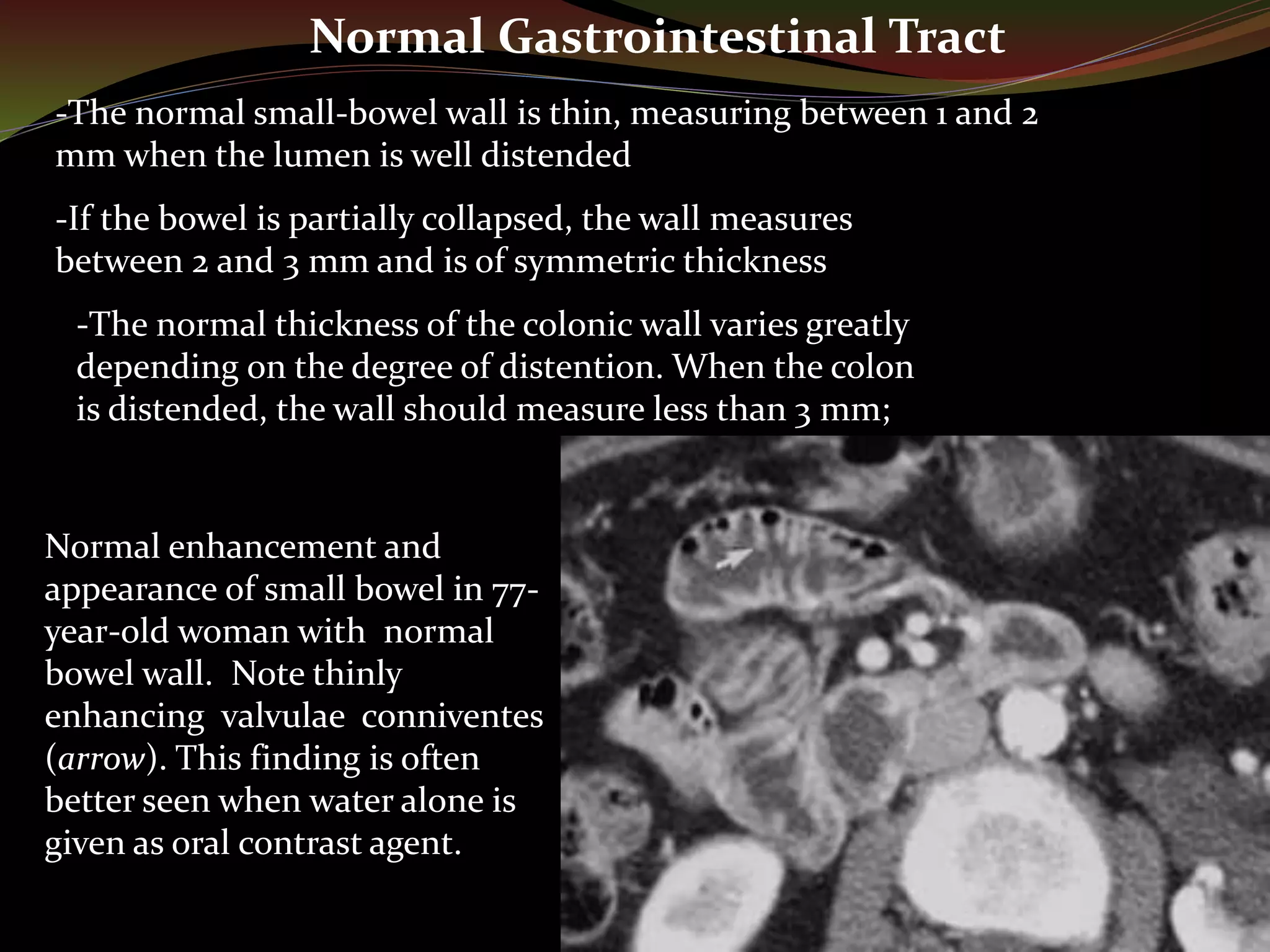 CT Imaging of Bowel Wall Thickening | PPTX