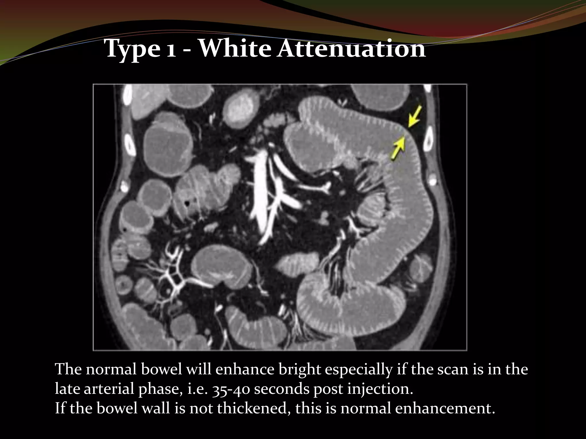 CT Imaging of Bowel Wall Thickening | PPTX