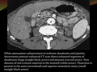 CT Imaging of Bowel Wall Thickening | PPTX