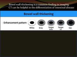 CT Imaging of Bowel Wall Thickening | PPTX