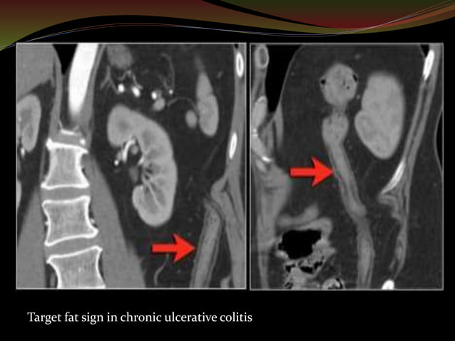 CT Imaging of Bowel Wall Thickening | PPTX | Digestive Disorders ...