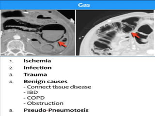 CT Imaging of Bowel Wall Thickening | PPTX