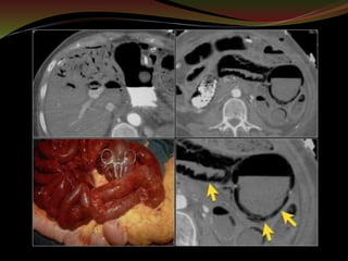 CT Imaging of Bowel Wall Thickening | PPTX