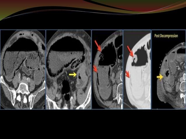 CT Imaging of Bowel Wall Thickening | PPTX | Digestive Disorders ...