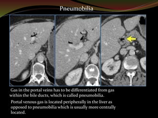 CT Imaging of Bowel Wall Thickening | PPTX