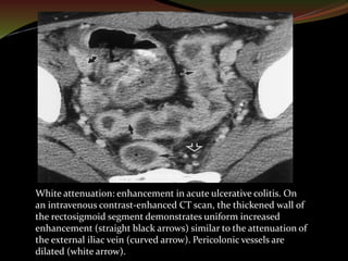 CT Imaging of Bowel Wall Thickening | PPT