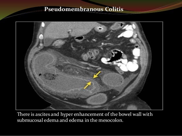 CT Imaging of Bowel Wall Thickening
