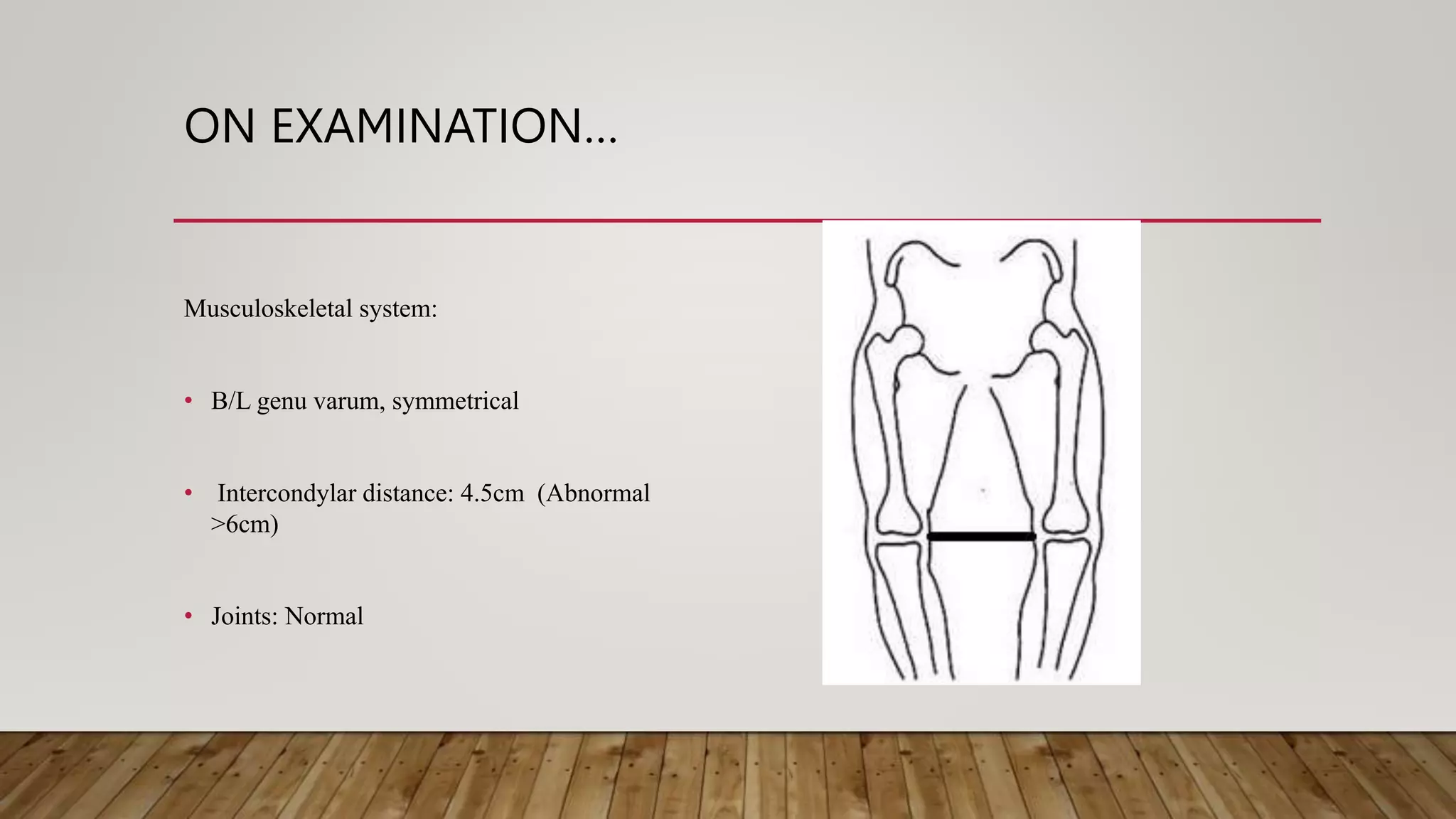 bowing legs.pptx | Bone and Joint Conditions | Diseases and Conditions
