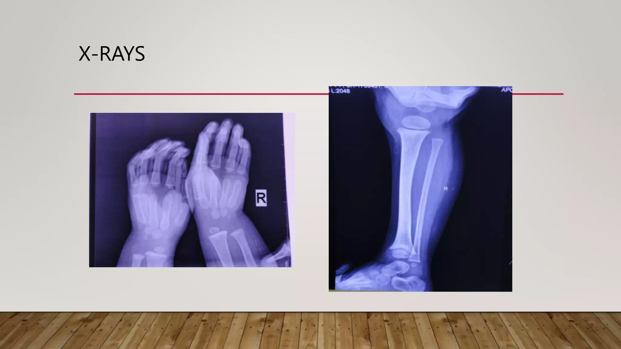 bowing legs.pptx | Bone and Joint Conditions | Diseases and Conditions