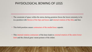 bowing legs.pptx