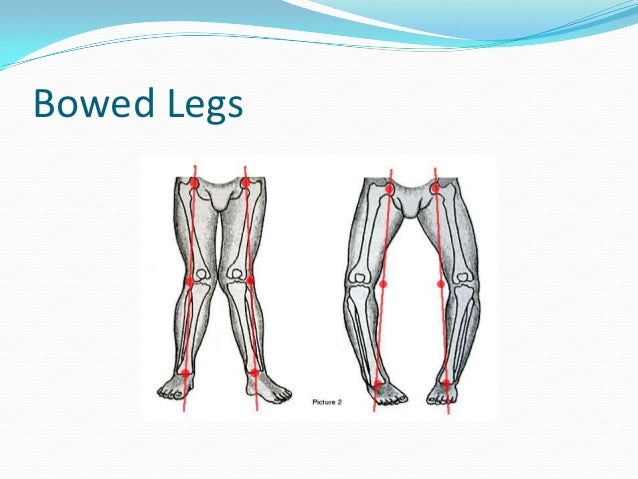 Bow Leg