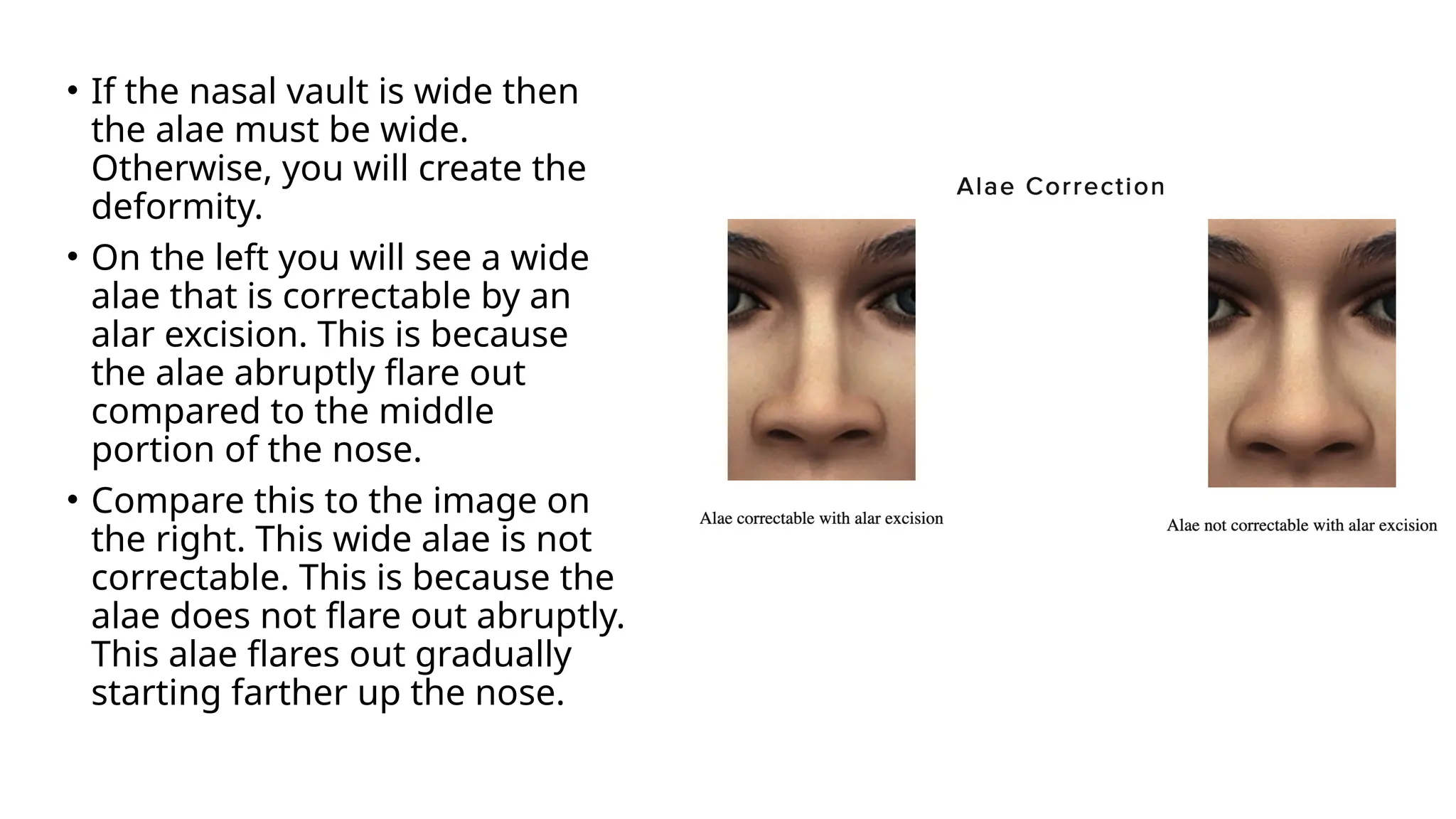 bowling pin deformity is a deformity of nose if the alar are corrected ...