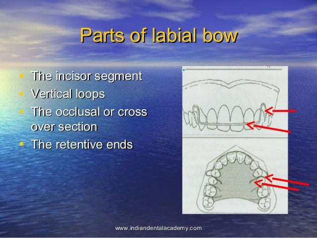 Bows /certified fixed orthodontic courses by Indian dental academy