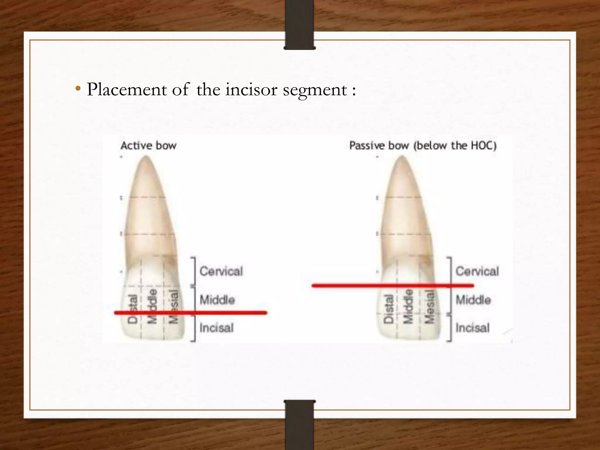 Bows and retractors for Undergraduates | PPTX