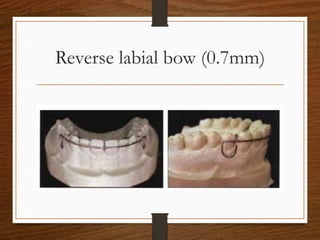 Bows and retractors for Undergraduates | PPTX