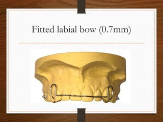 Bows and retractors for Undergraduates | PPTX