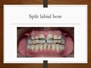 Bows and retractors for Undergraduates | PPTX