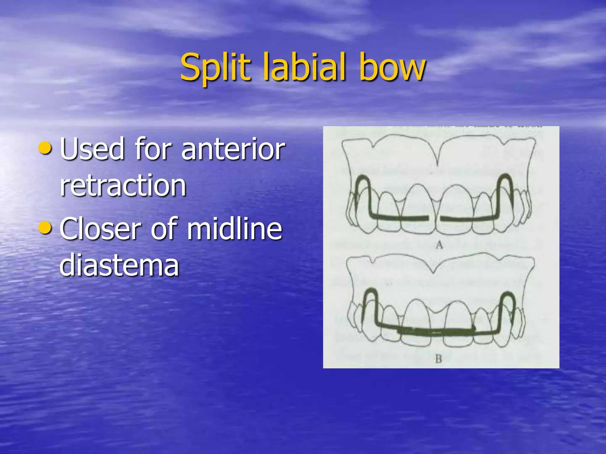 BOWS Siddharth.PPT