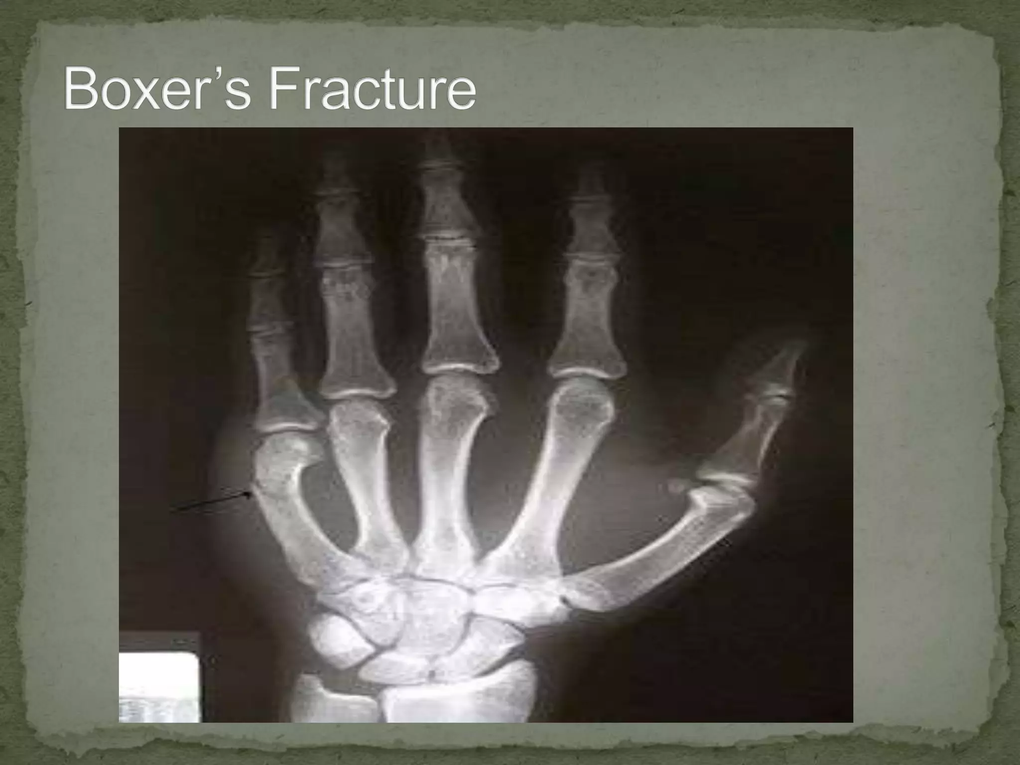 Boxers fracture Power Point | PPTX