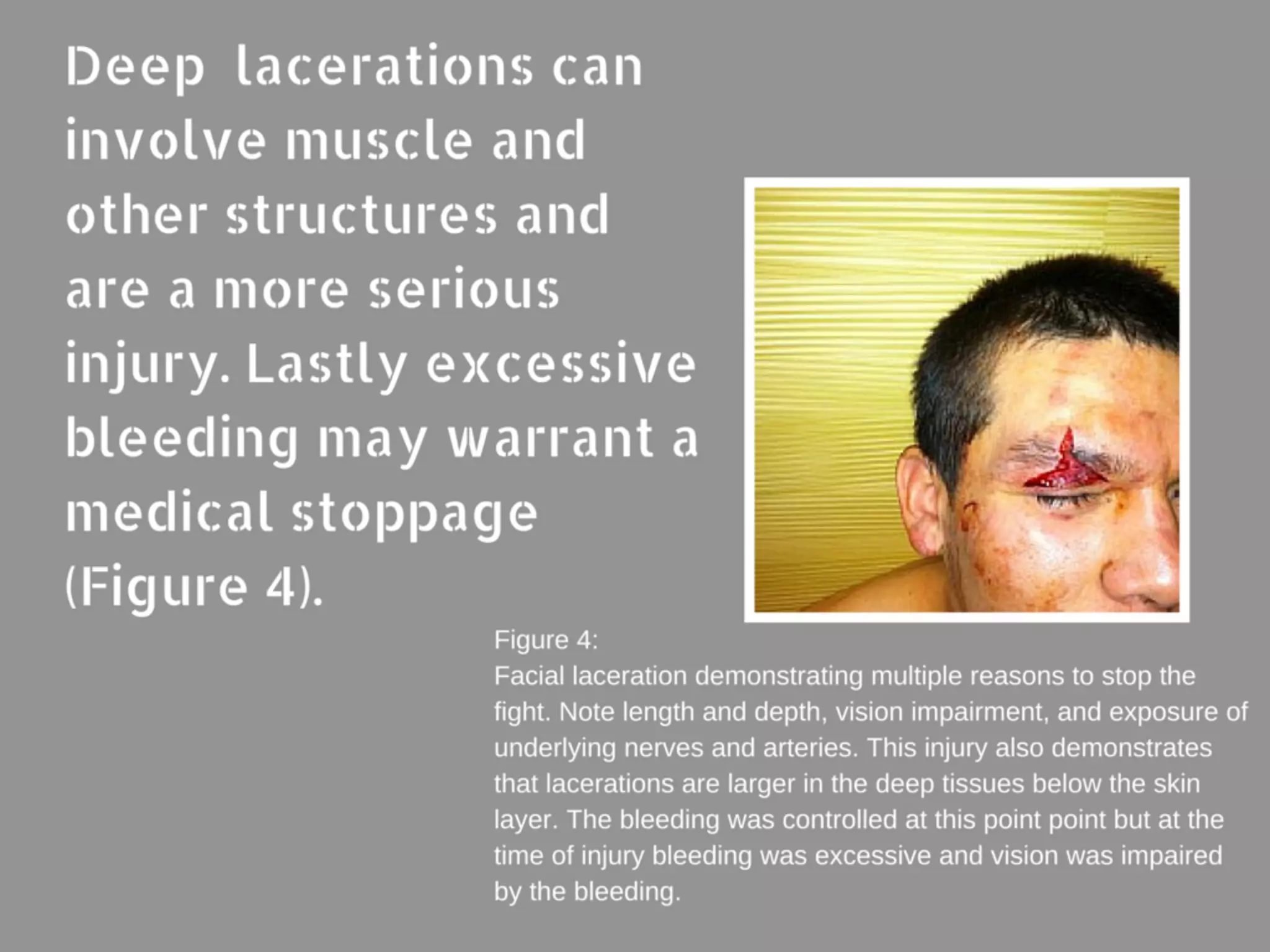 Boxing Injuries: Lacerations | PDF