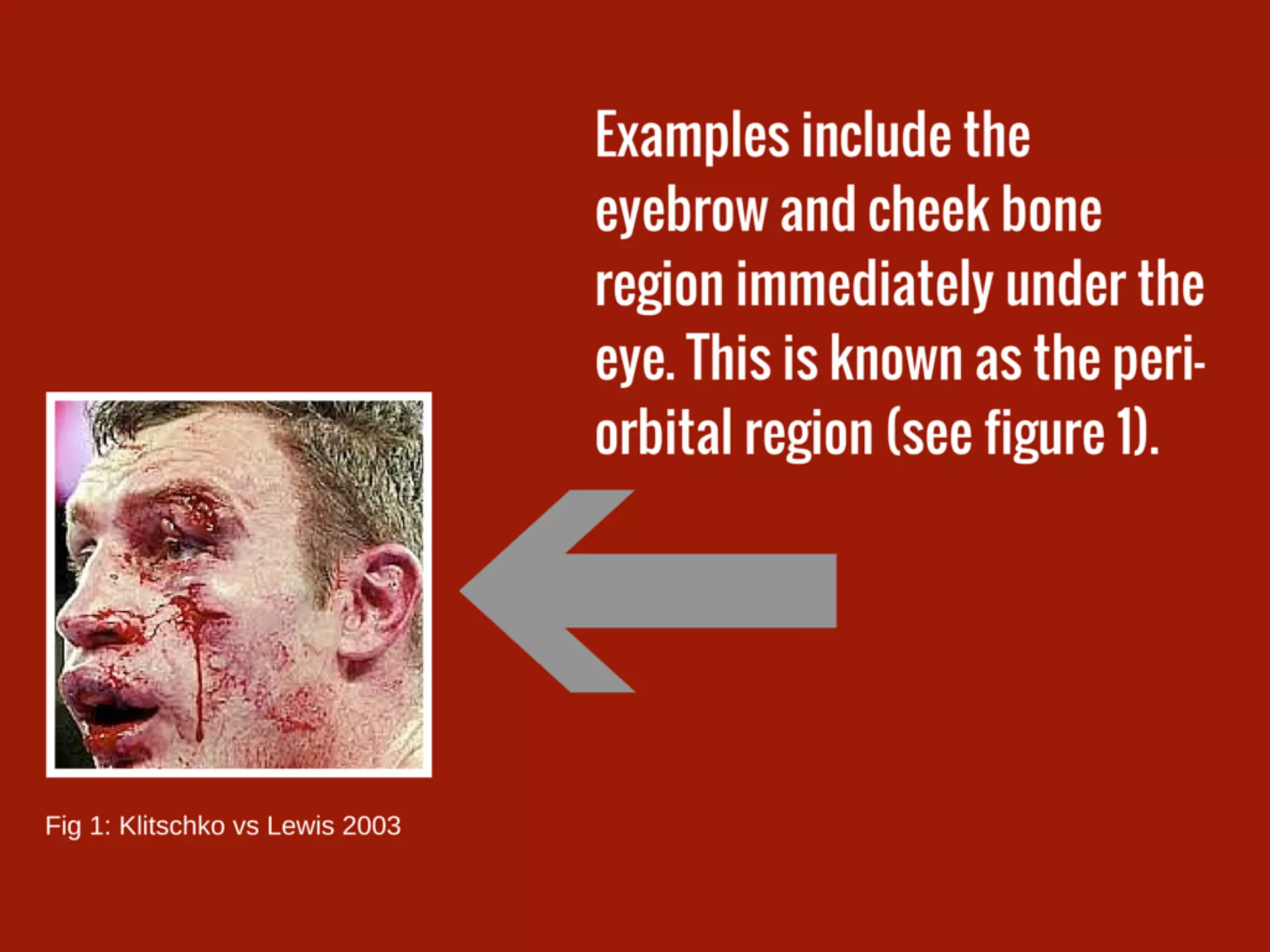 Boxing Injuries: Lacerations | PDF
