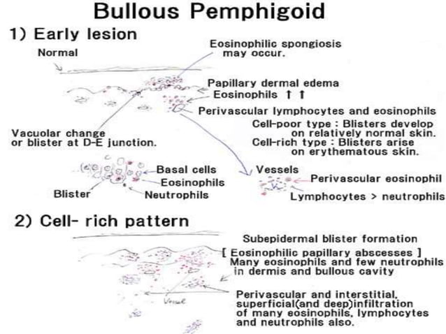 Bullous pemphigoid , dermatitis herpitiformis and cbdc | PPTX | Skin ...