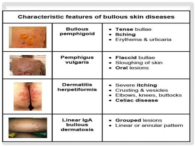 Bullous pemphigoid , dermatitis herpitiformis and cbdc
