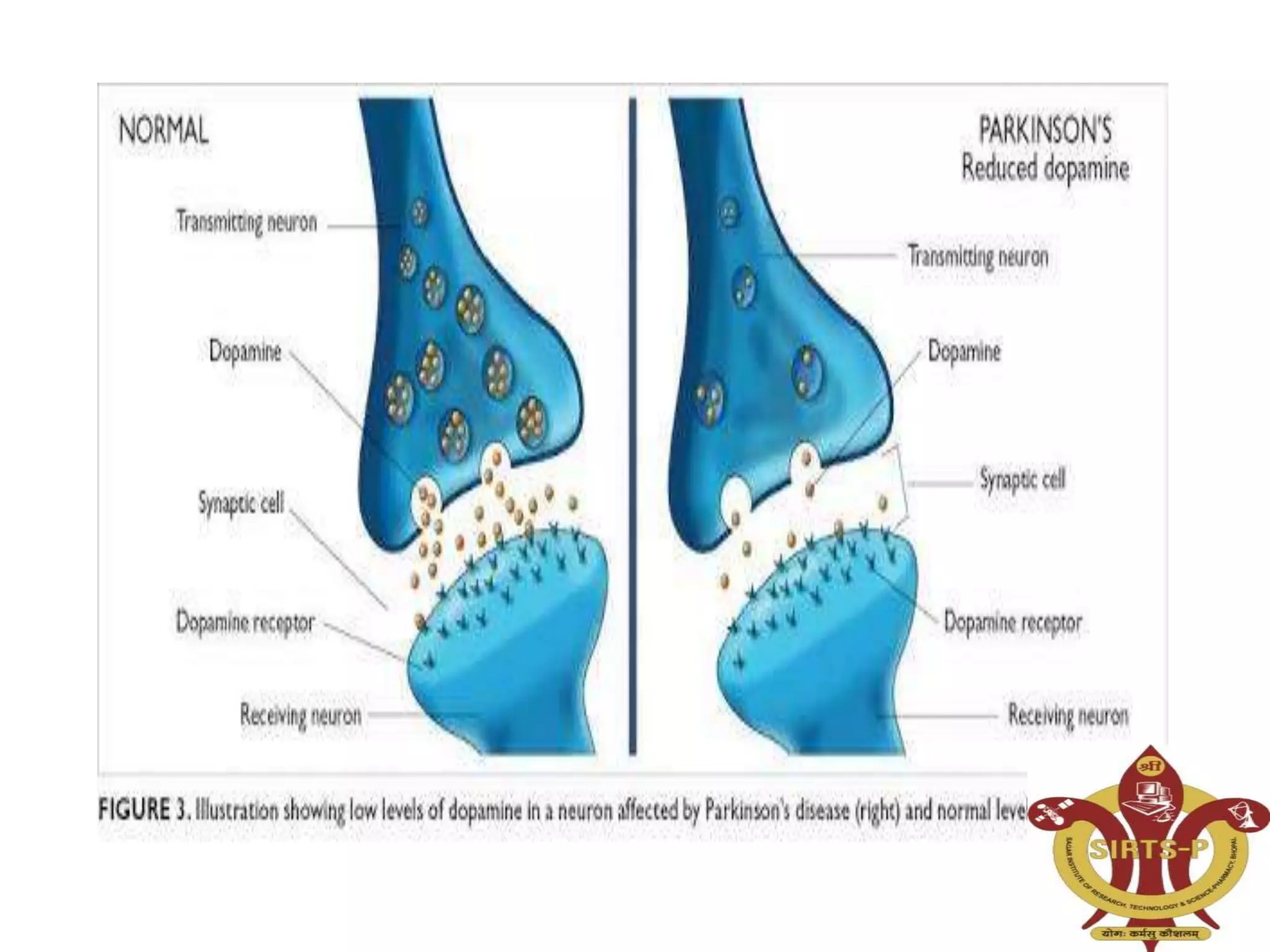 Parkinson's disease & pathophysiology | PPTX
