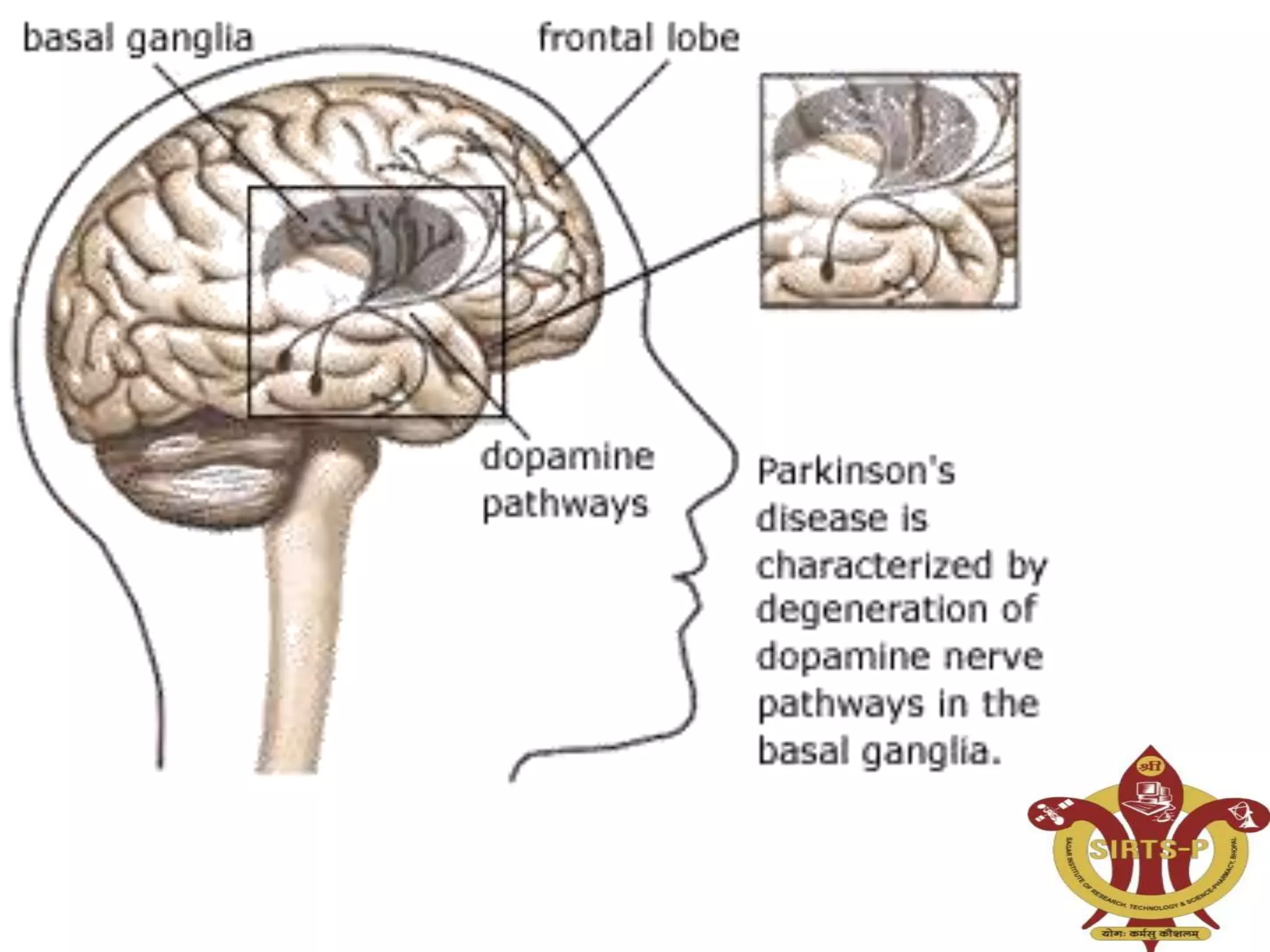 Parkinson's disease & pathophysiology | PPTX