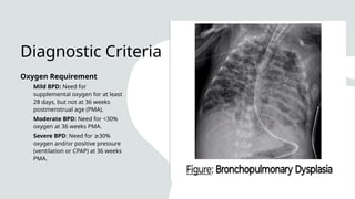 BPD (Bronchopulmonary Dysplasia): Diagnostic Criteria, Treatment | PPTX