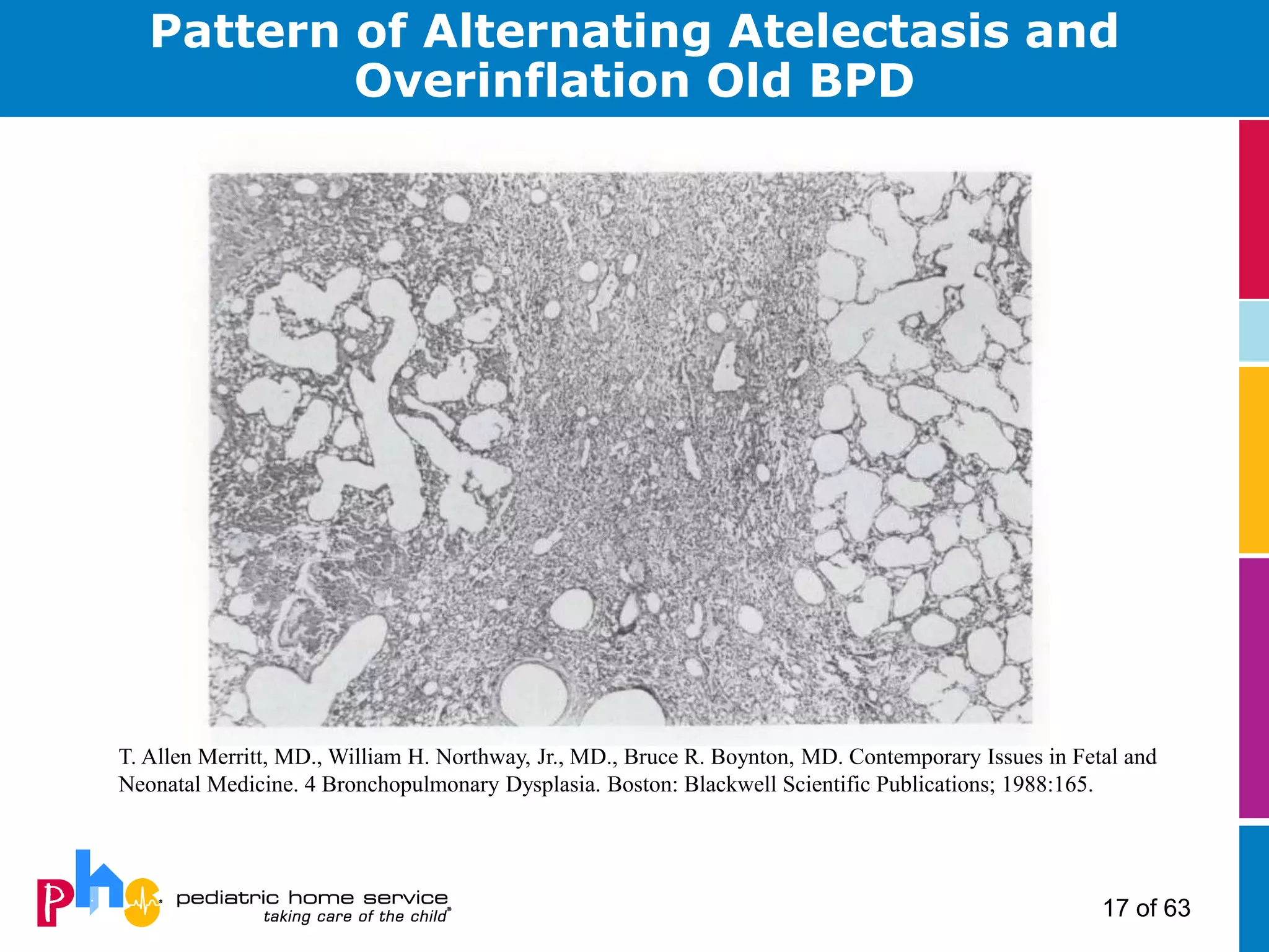 An Overview of Bronchopumonary Displasia (BPD) | PDF