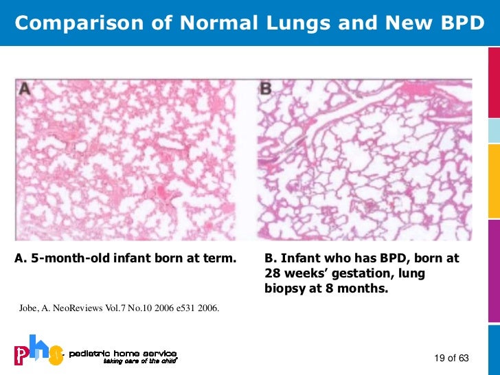 An Overview of Bronchopumonary Displasia (BPD)