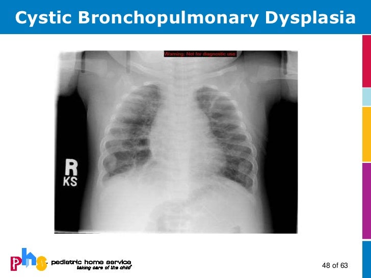 An Overview of Bronchopumonary Displasia (BPD)