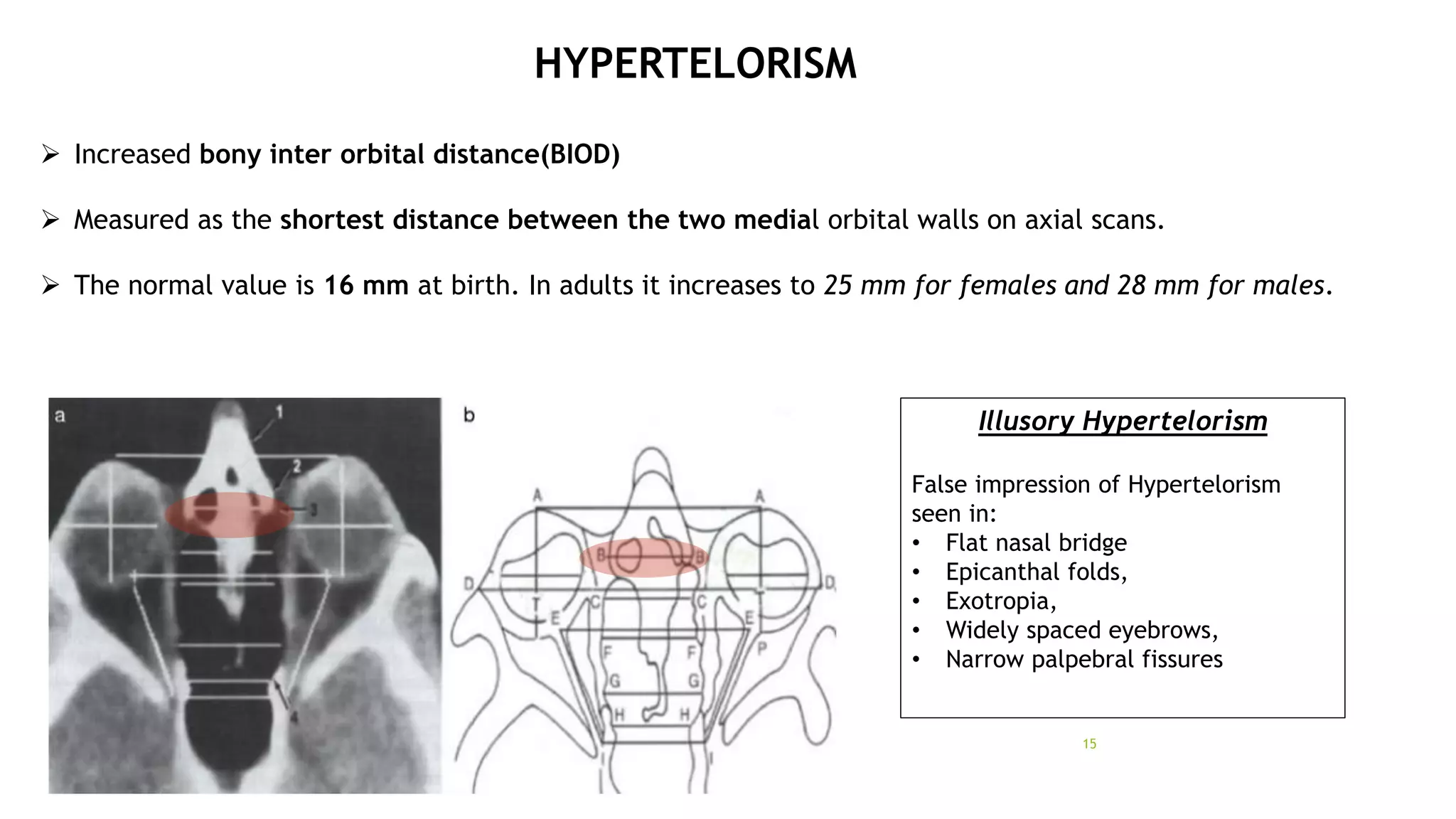 Blepharophimosis Ptosis Epicanthus inversus Syndrome (BPES) | PPTX