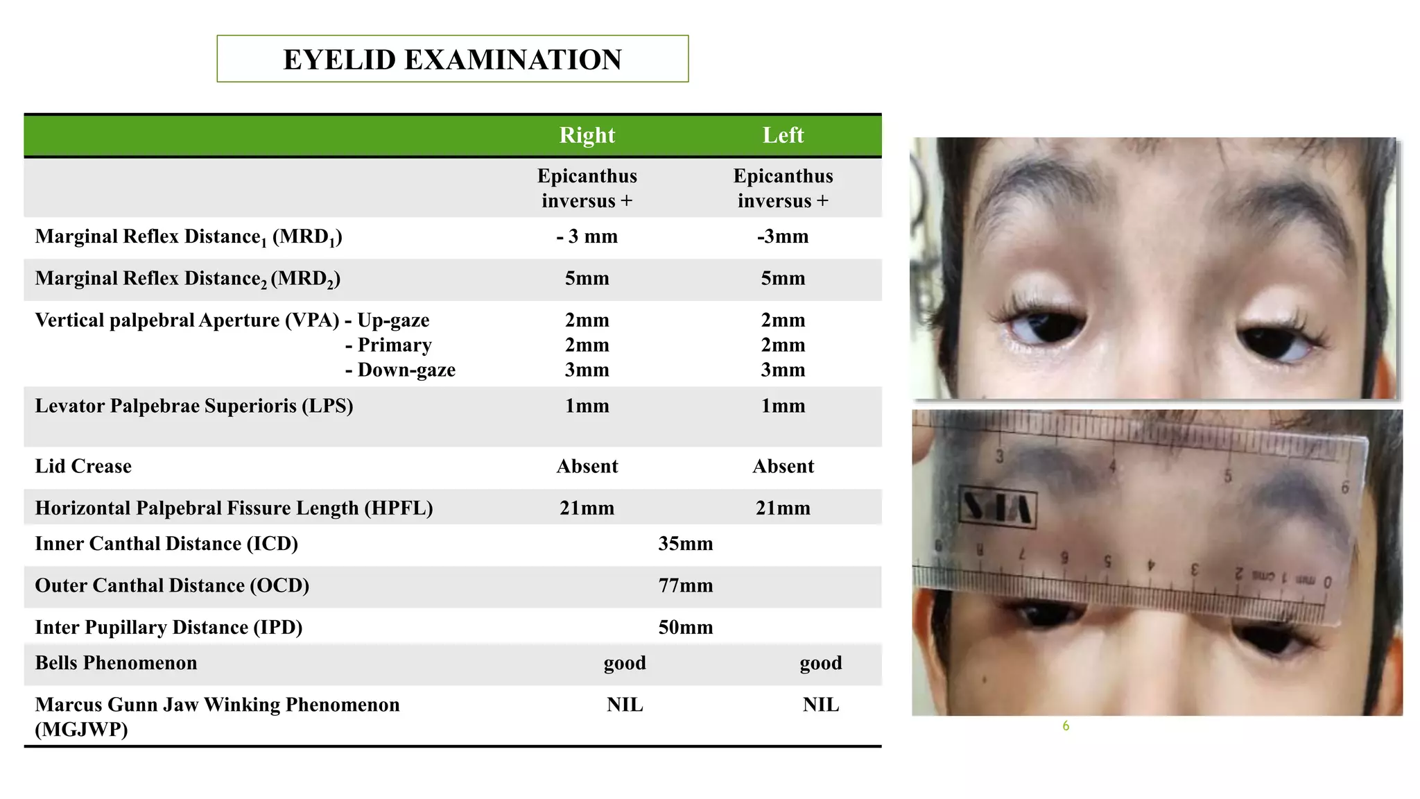 Blepharophimosis Ptosis Epicanthus inversus Syndrome (BPES) | PPTX
