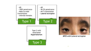 Blepharophimosis Ptosis Epicanthus inversus Syndrome (BPES) | PPTX