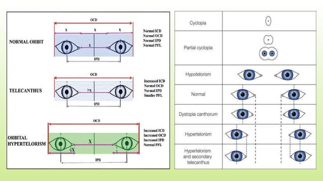 Blepharophimosis Ptosis Epicanthus inversus Syndrome (BPES) | PPTX ...