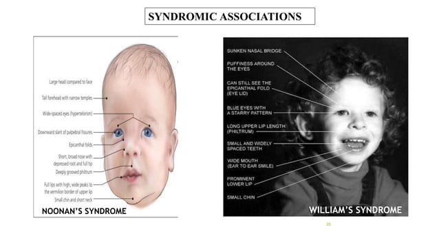 Blepharophimosis Ptosis Epicanthus inversus Syndrome (BPES) | PPTX ...