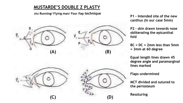 Blepharophimosis Ptosis Epicanthus inversus Syndrome (BPES) | PPTX ...