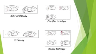 Blepharophimosis Ptosis Epicanthus inversus Syndrome (BPES) | PPTX
