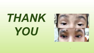 Blepharophimosis Ptosis Epicanthus inversus Syndrome (BPES) | PPTX